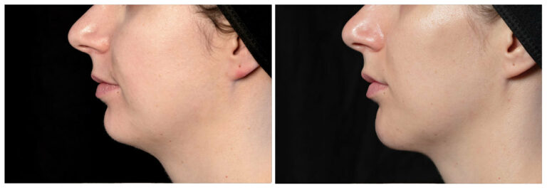 Juvederm Jowls: Before and After Photos - Beauty Dermal