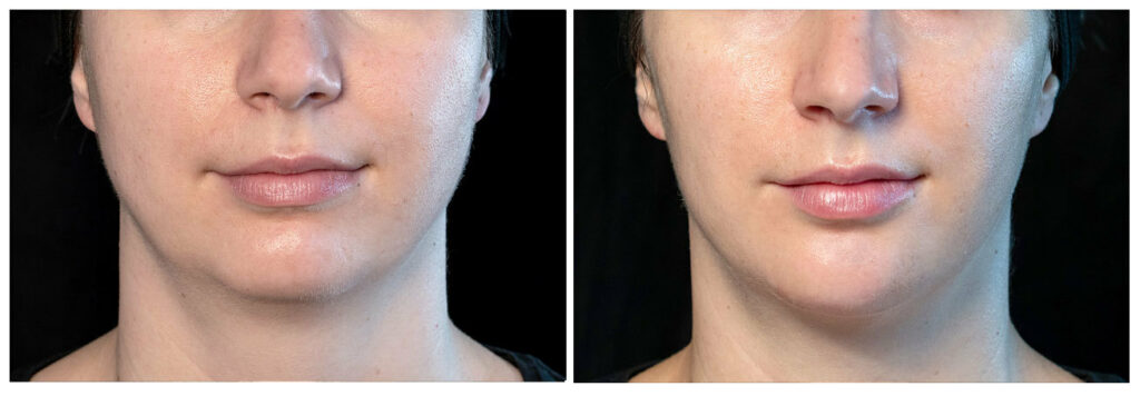 Juvederm Jowls: Before and After Photos - Beauty Dermal