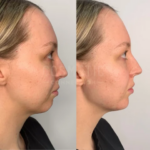 Juvederm Jowls: Before and After Photos - Beauty Dermal