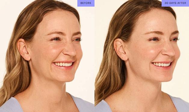 Full Face Botox: Before- and After-Treatment Considerations and ...