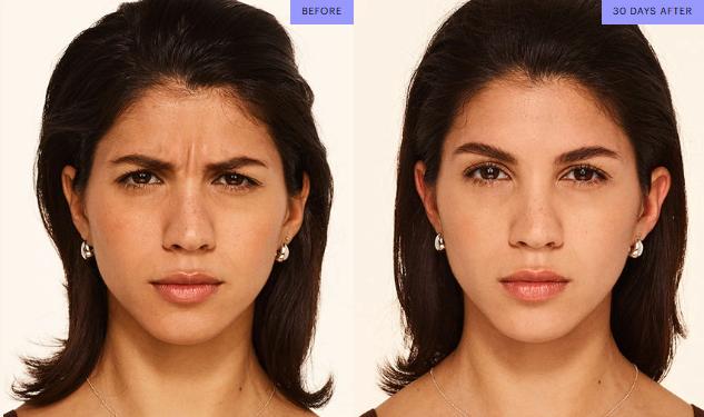 Full Face Botox: Before- and After-Treatment Considerations and ...